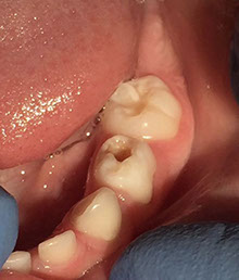 Pediatric Dentistry Procedures | Bergen Pediatric Dentistry in Fair Lawn NJ